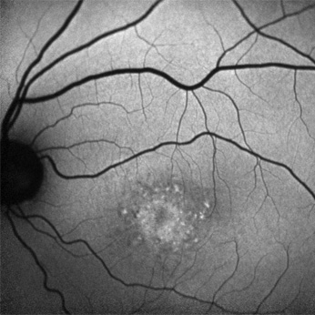 Rare eye diseases - The University Hospital of Ophthalmology